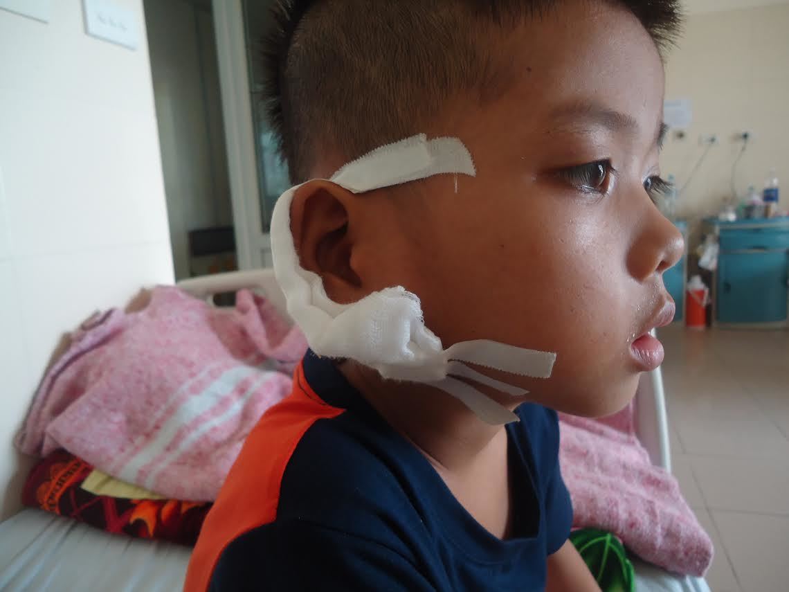 U tuyến mang tai, cuộc đời con rơi vào câm lặng!